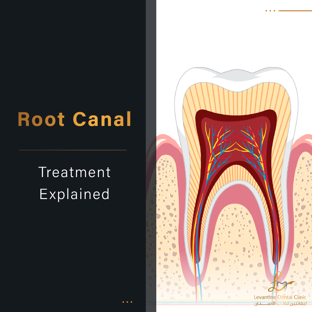 Root Canal Treatment Explained