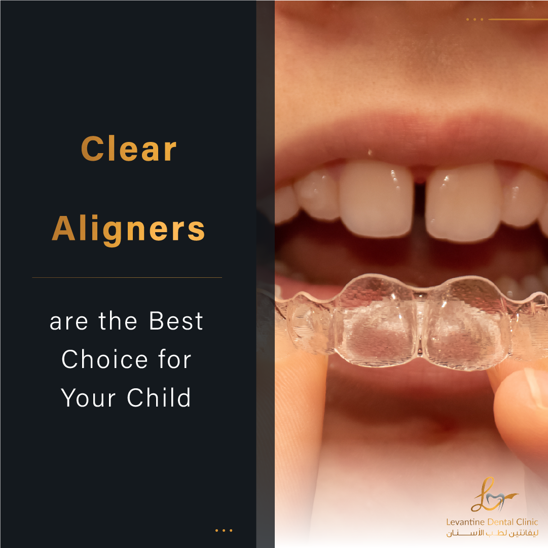 Why Clear Aligners Are The Choice For Your Child's Orthodontic Treatment